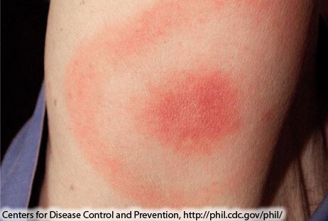 Lyme Disease Rash: What It Really Looks Like And What To Do Next